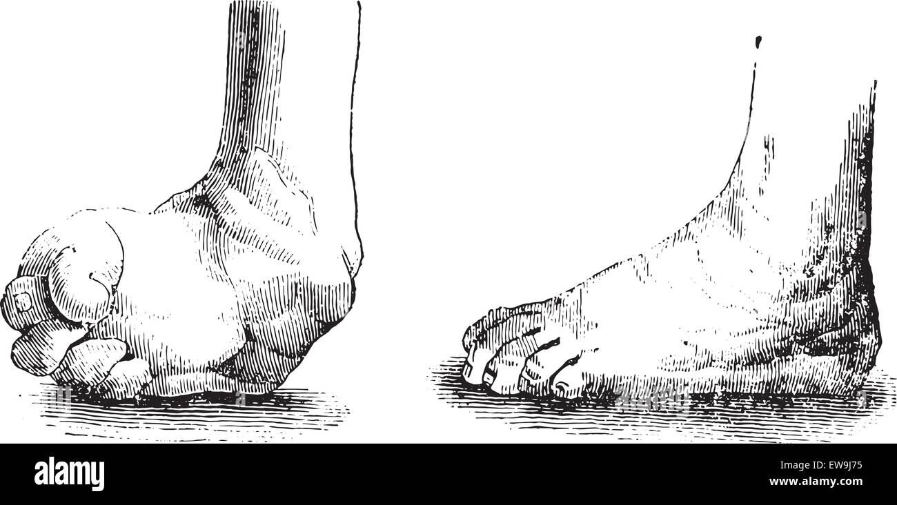 Un pied bot ou pied bot congénital ou talipes equinovarus (CTEV) equine ...