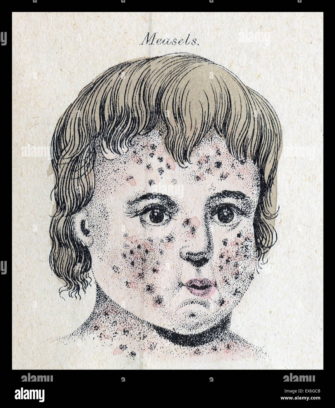 Rougeole enfant Banque de photographies et d’images à haute résolution ...