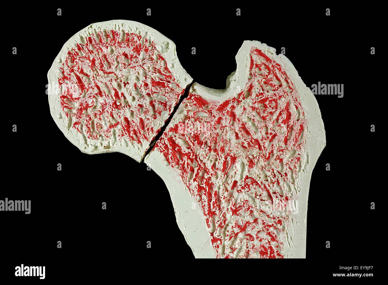 Section transversale à travers un modèle d'une fracture du col du fémur ...