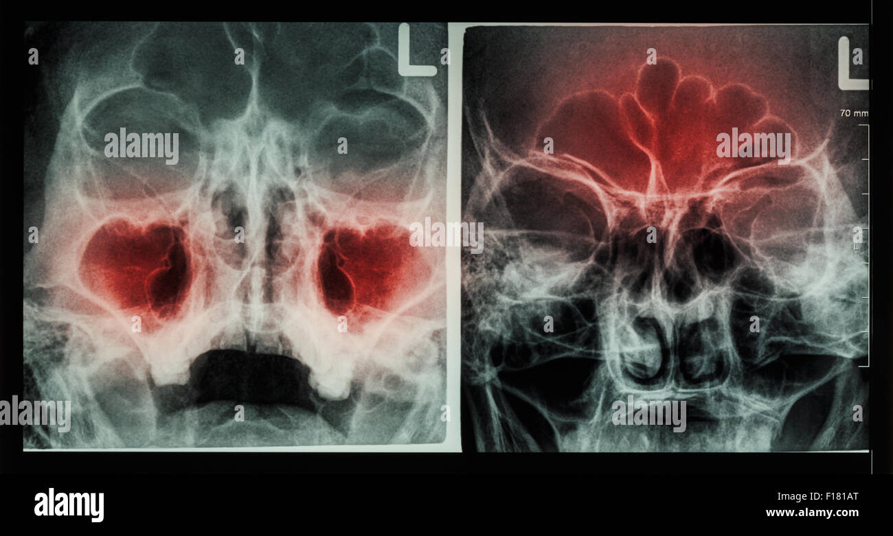 Traitement de la sinusite Banque de photographies et d’images à haute ...