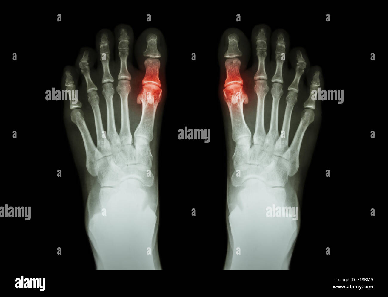 La goutte, l'arthrite rhumatoïde ( Film x-ray les deux pieds et de l ...