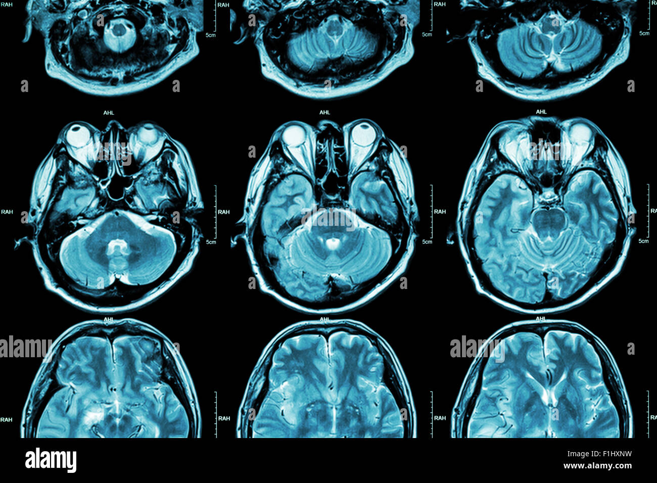 Irm du cerveau (section transversale du cerveau ) ( Medical , soins de santé , Sciences Photo ...