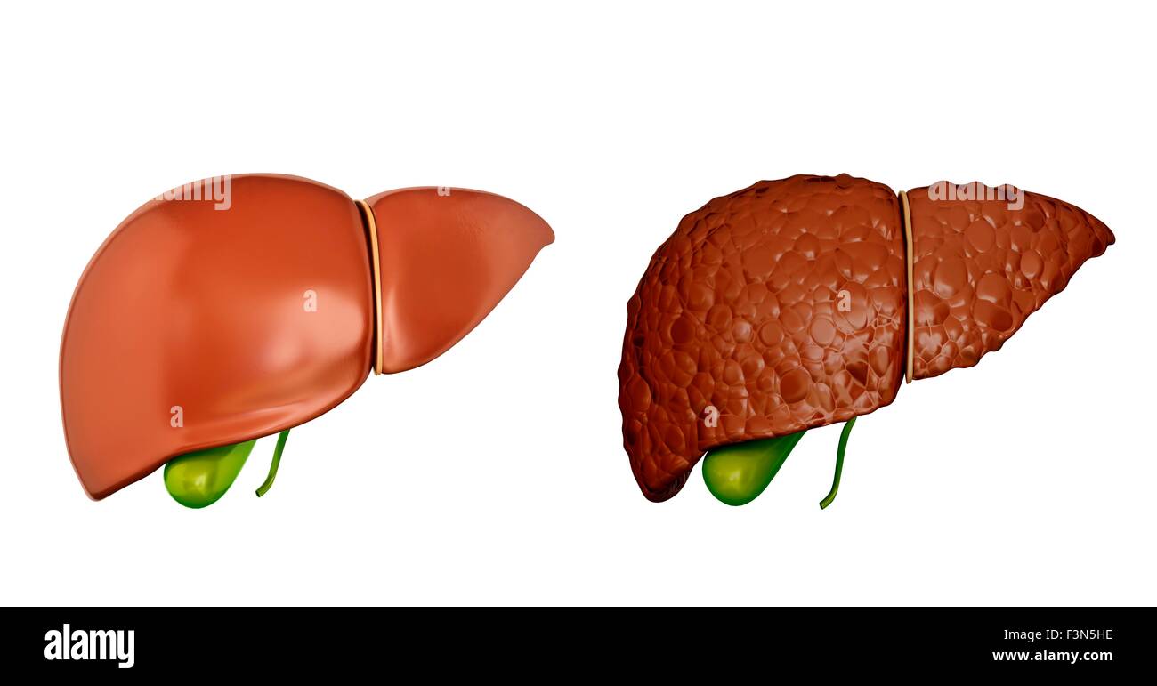 Liver cirrhosis Banque de photographies et d’images à haute résolution ...