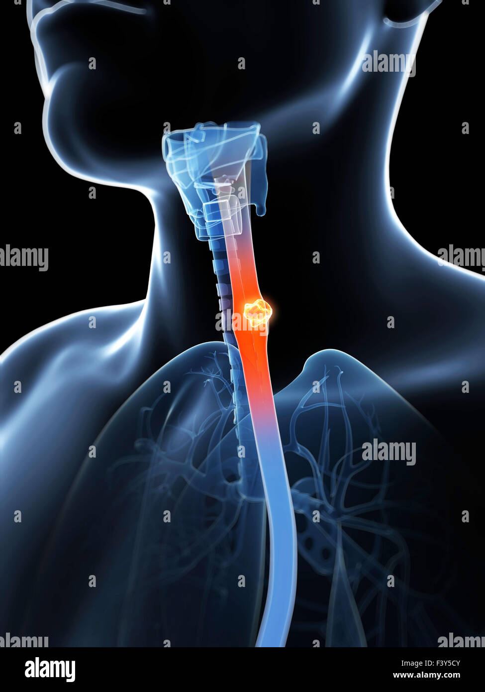 Cancer de l'oesophage Banque de photographies et d’images à haute résolution - Alamy