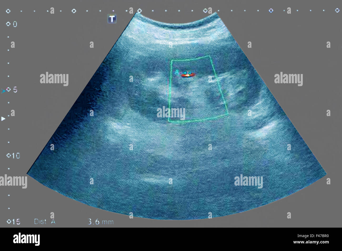 La lithiase rénale, échographie Photo Stock - Alamy