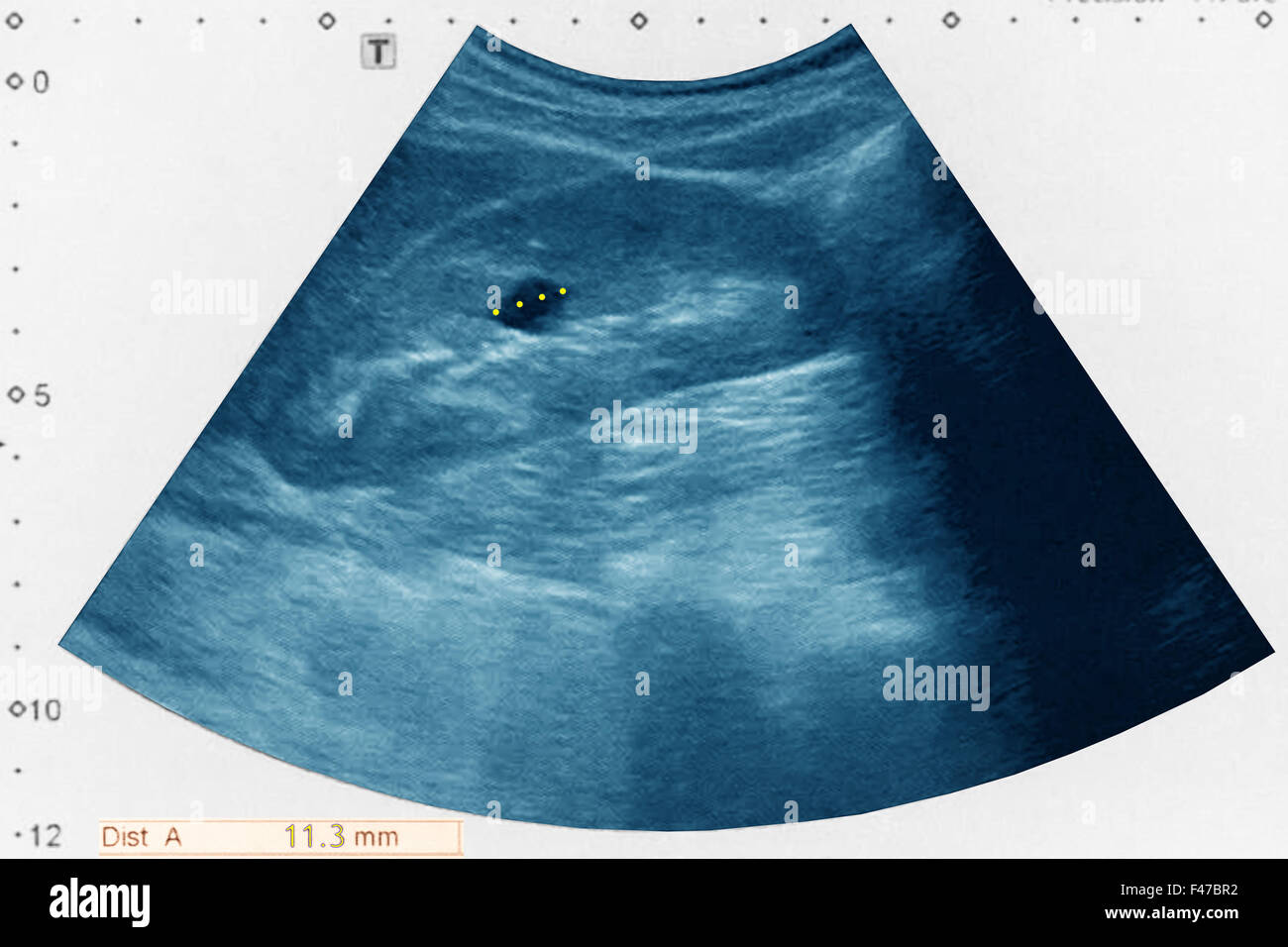 Kyste rénal, échographie Photo Stock - Alamy