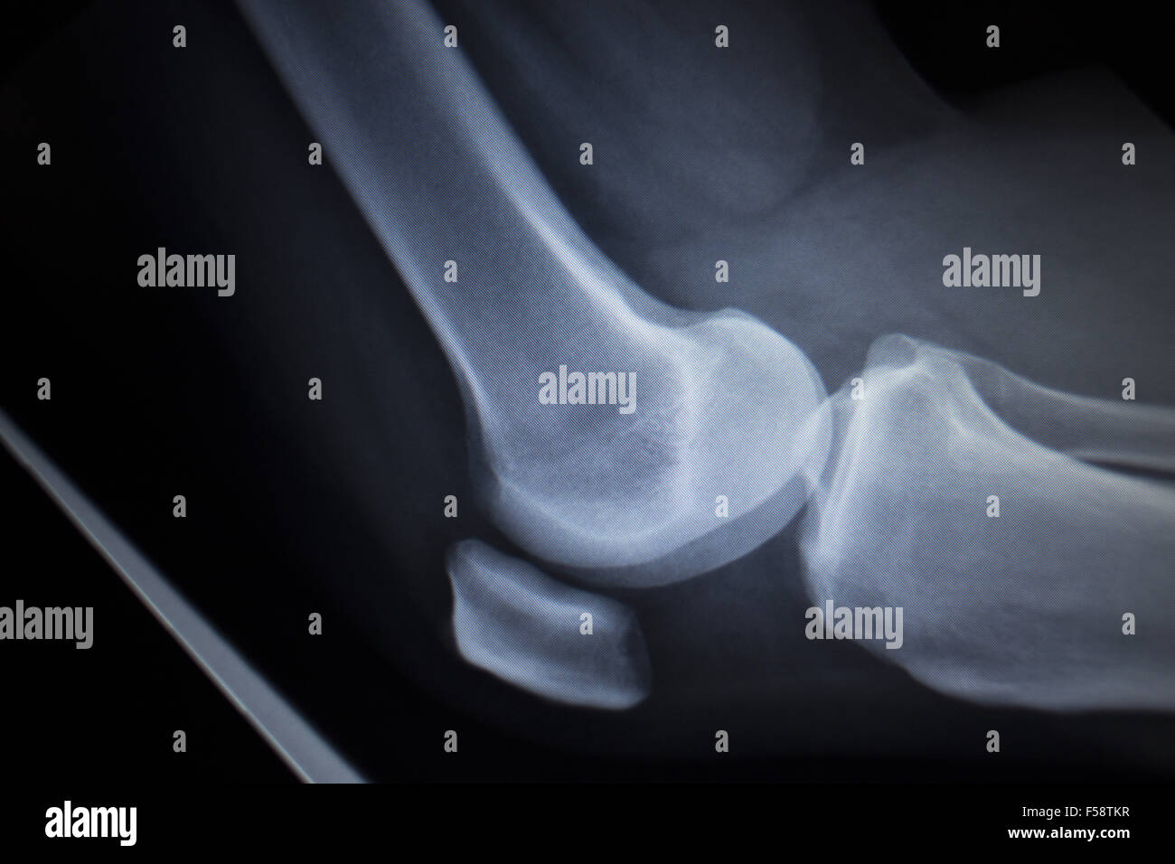 X-ray scanner médical orthopédique de ménisque du genou jambe ...