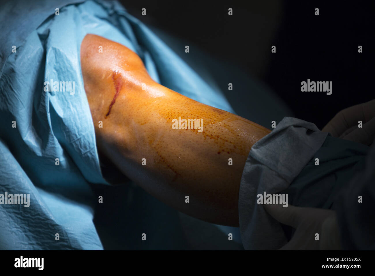 Chirurgie orthopédique traumatologie d'urgence de l'hôpital salle d ...