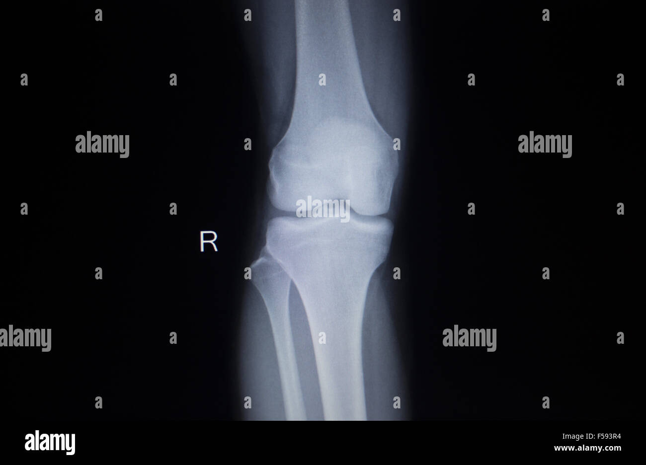 X-ray scanner médical orthopédique de ménisque du genou jambe ...