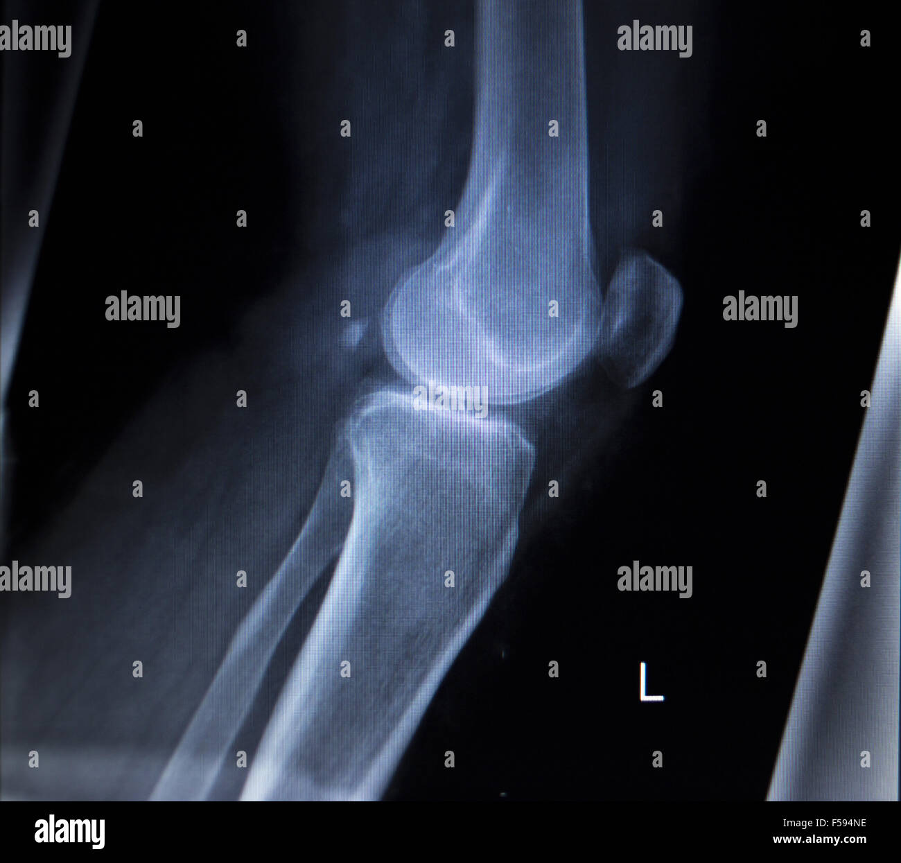 X-ray scanner médical orthopédique de ménisque du genou jambe ...