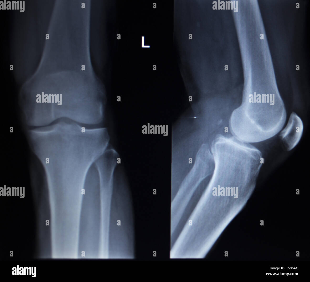 X-ray scanner médical orthopédique de ménisque du genou jambe ...