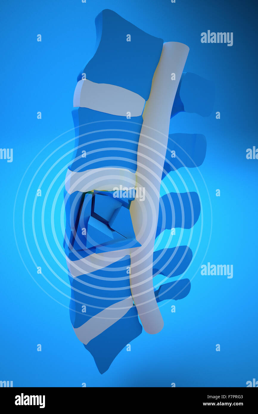 Traumatic fractures vertebral Banque de photographies et d’images à ...