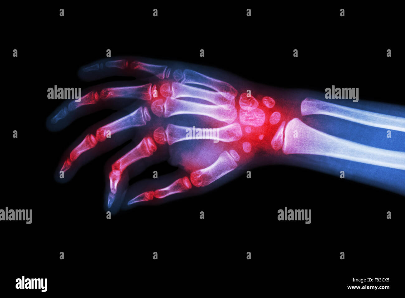 L'arthrite rhumatoïde, l'arthrite goutteuse ( Film x-ray main de l ...