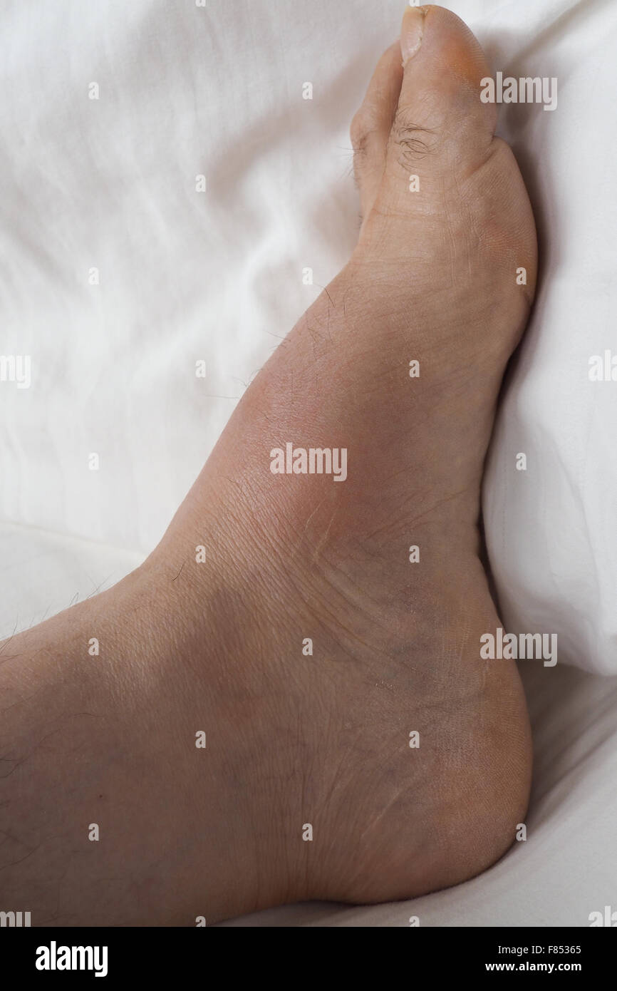 Acide urique Banque de photographies et d’images à haute résolution - Alamy