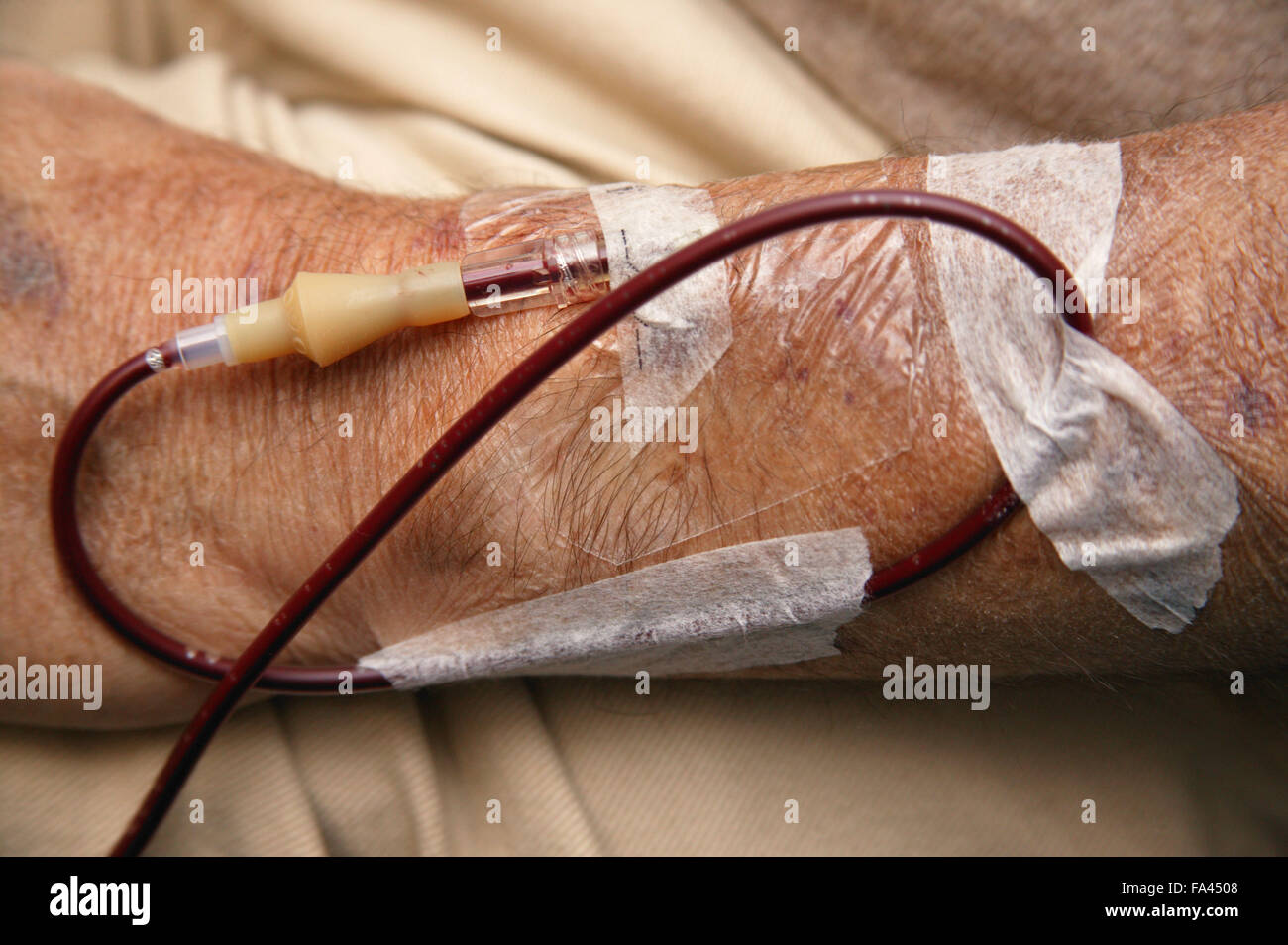 Close up of arm de patient qui est l'objet d'une transfusion de sang ...