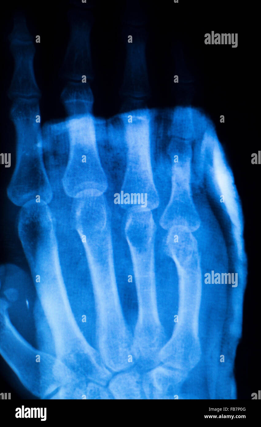 La main, les doigts et le pouce l'hôpital x-ray scanner les résultats ...