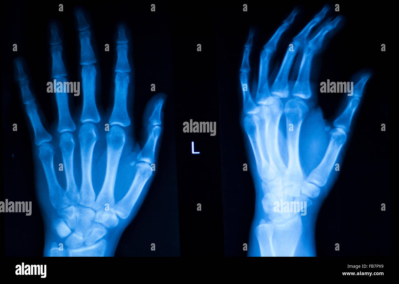 La main, les doigts et le pouce l'hôpital x-ray scanner les résultats ...