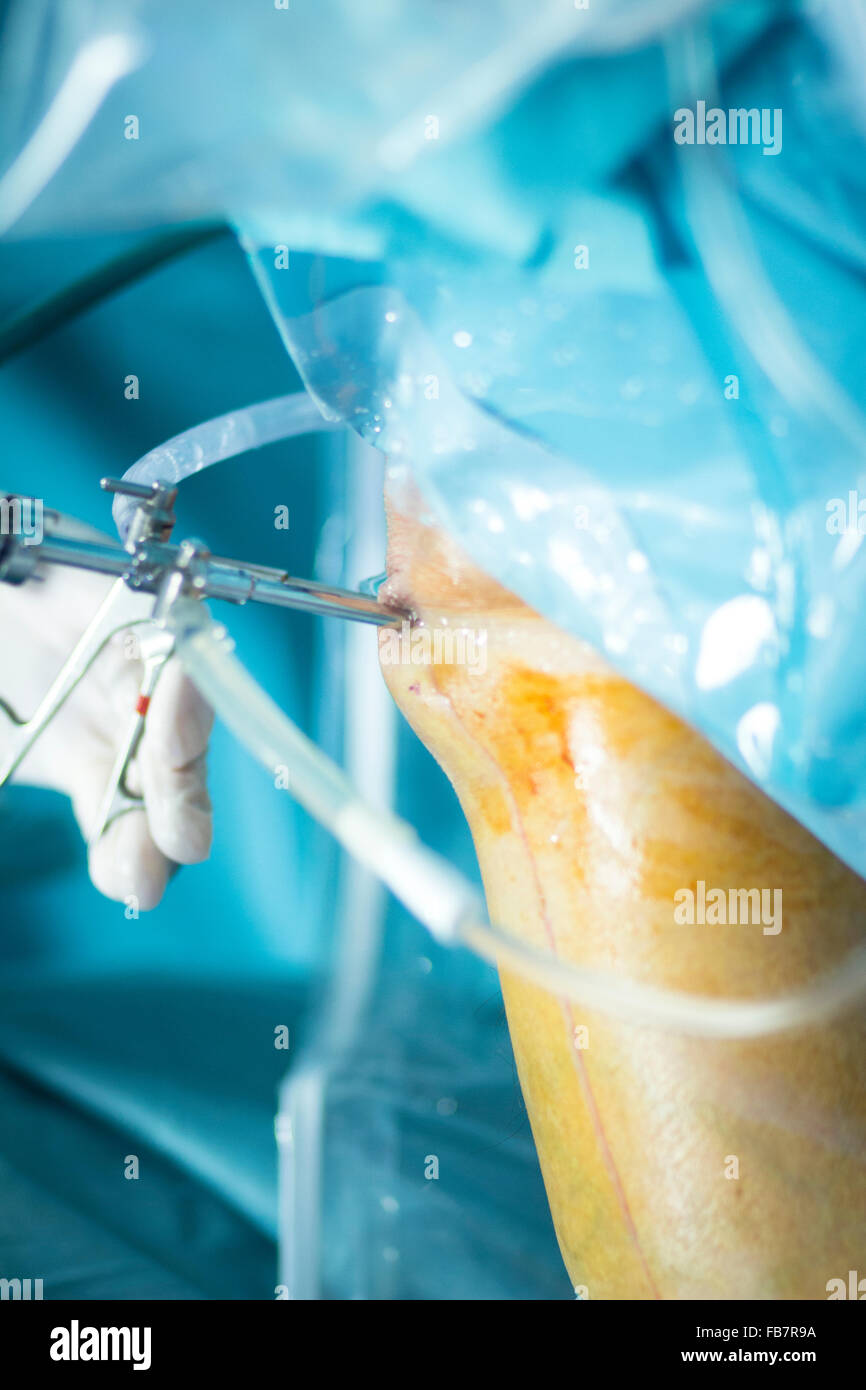 Chirurgie du genou orthopédie traumatologie opération chirurgicale de l ...