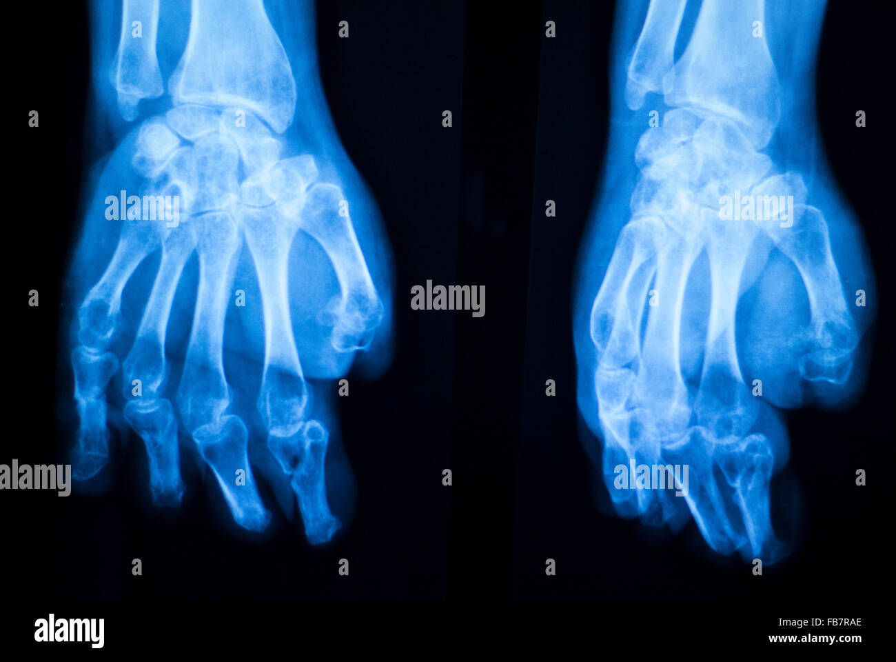 La main, les doigts et le pouce l'hôpital x-ray scanner les résultats ...
