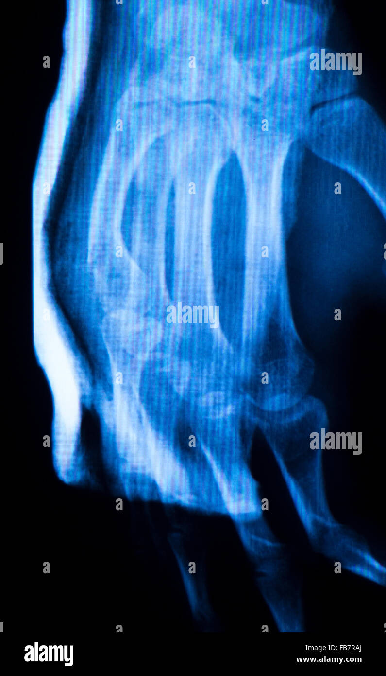 La main, les doigts et le pouce l'hôpital x-ray scanner les résultats ...