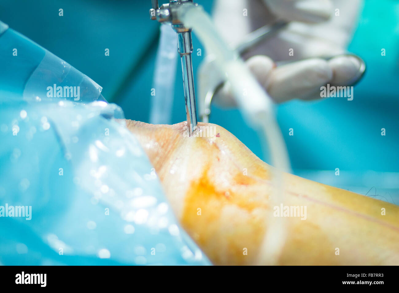 Chirurgie du genou orthopédie traumatologie opération chirurgicale de l ...