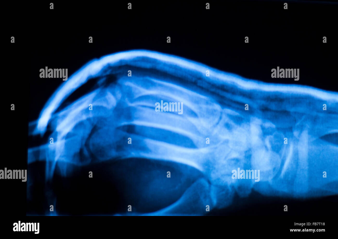 La main, les doigts et le pouce l'hôpital x-ray scanner les résultats ...