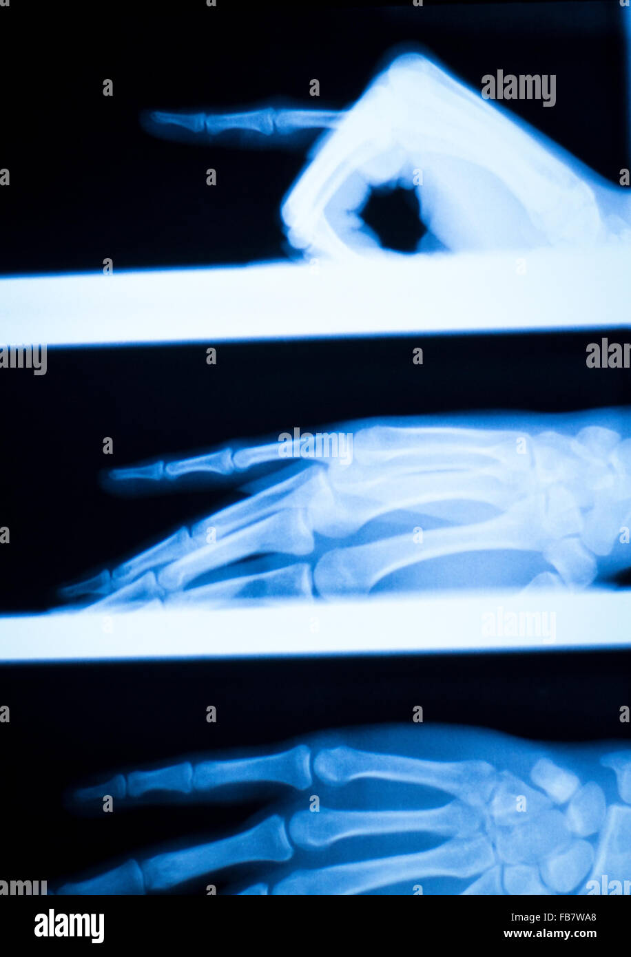 La main, les doigts et le pouce l'hôpital x-ray scanner les résultats ...