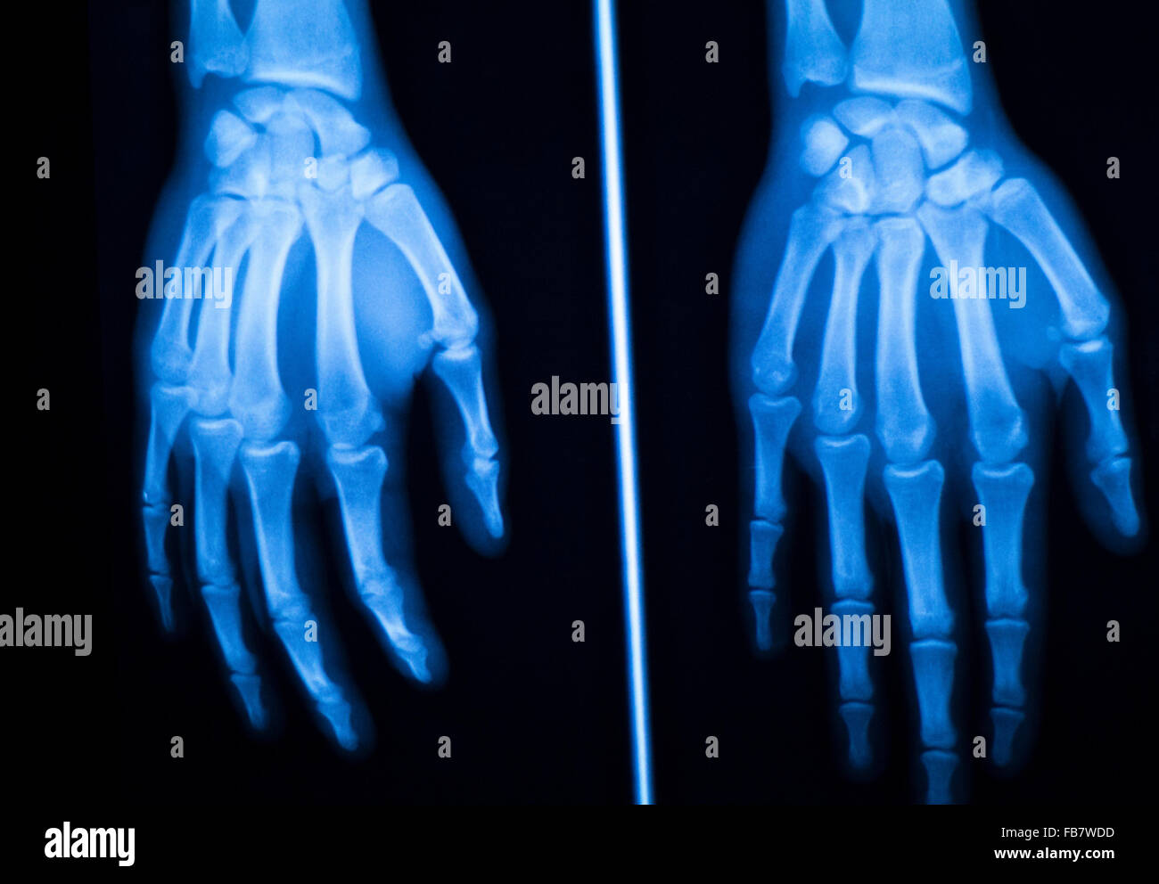 La main, les doigts et le pouce l'hôpital x-ray scanner les résultats ...