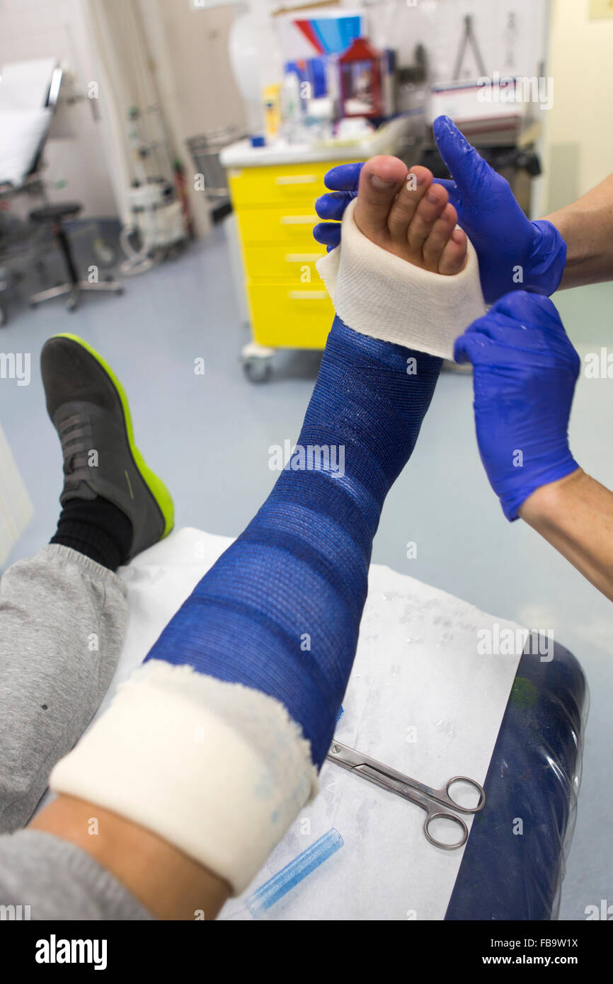 Plâtre sur une jambe fracturée Photo Stock - Alamy