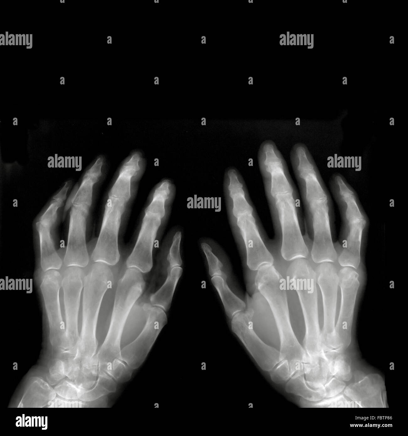 Os xray Banque de photographies et d’images à haute résolution - Alamy