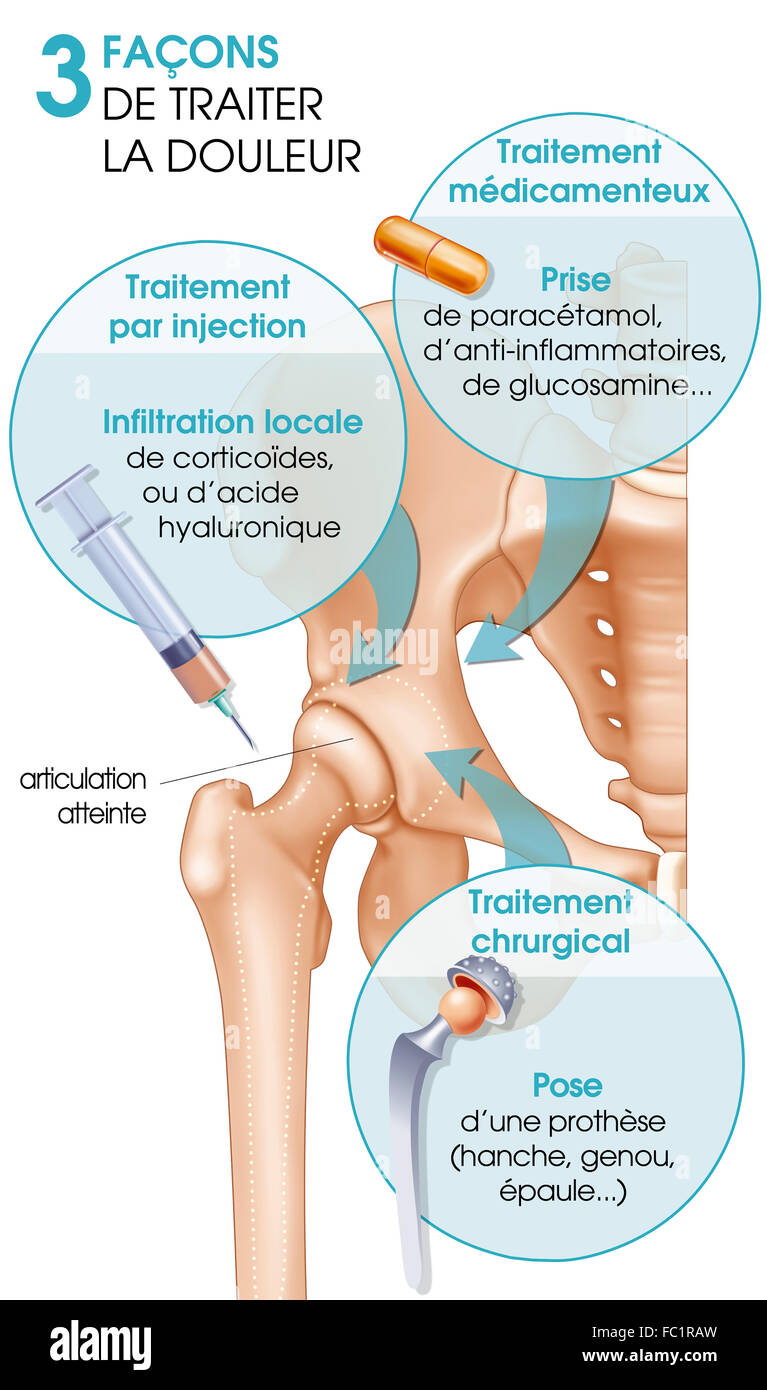 Articulations douloureuses de la hanche humaine Banque de photographies ...
