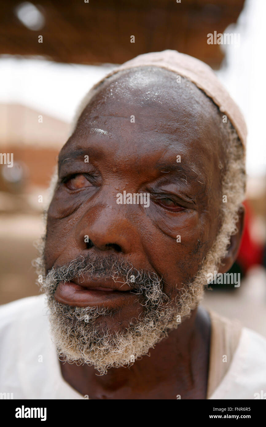 Lèpre maladie visage Banque de photographies et d’images à haute ...