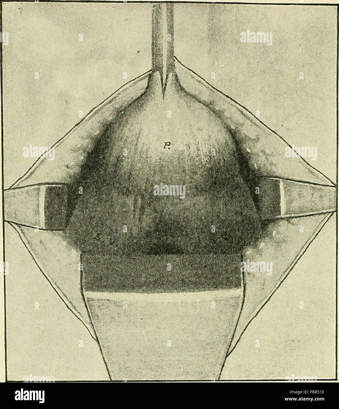 Hypertrophie prostatique Banque de photographies et d’images à haute ...