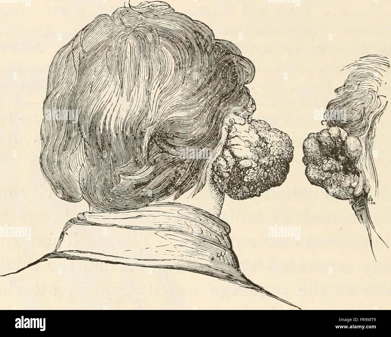 Le Pathological Anatomy of the Ear (1878) étudie les maladies et les ...