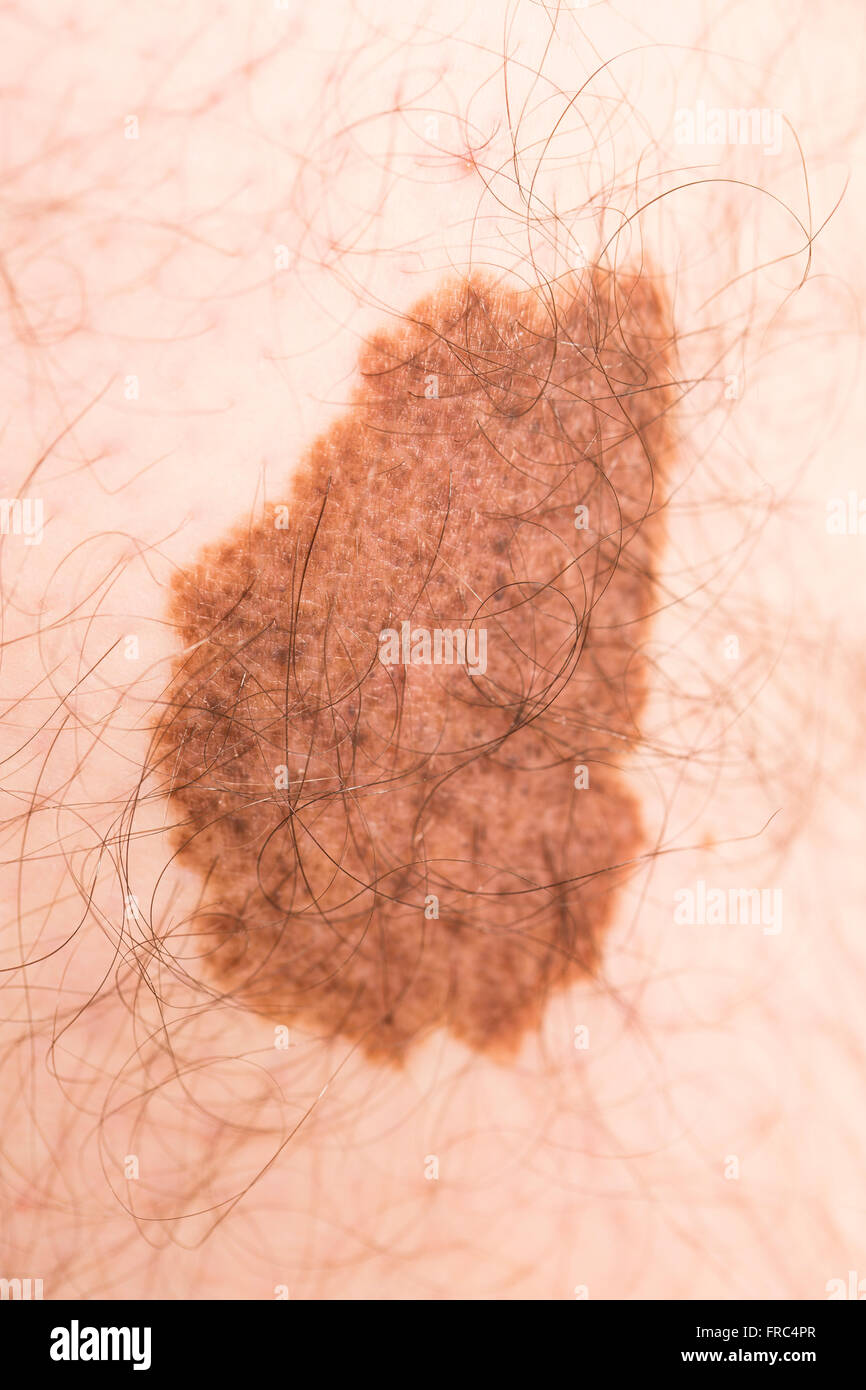 Mélanome benin Banque de photographies et d’images à haute résolution - Alamy