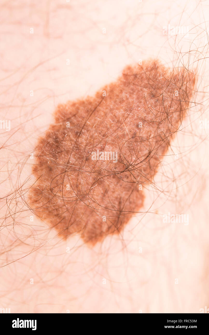 Mélanome benin Banque de photographies et d’images à haute résolution - Alamy