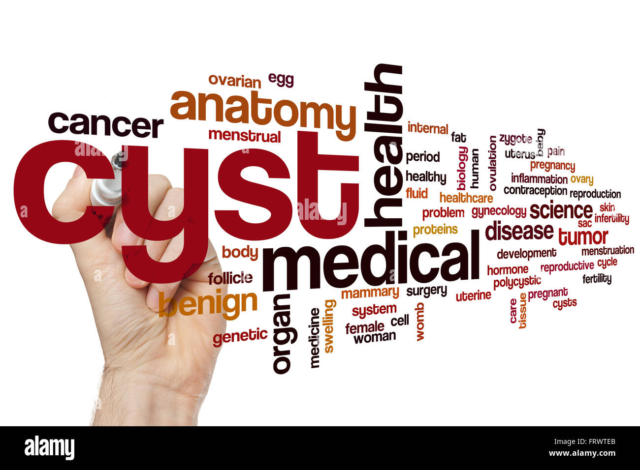 Kyste de l'ovaire Banque de photographies et d’images à haute ...
