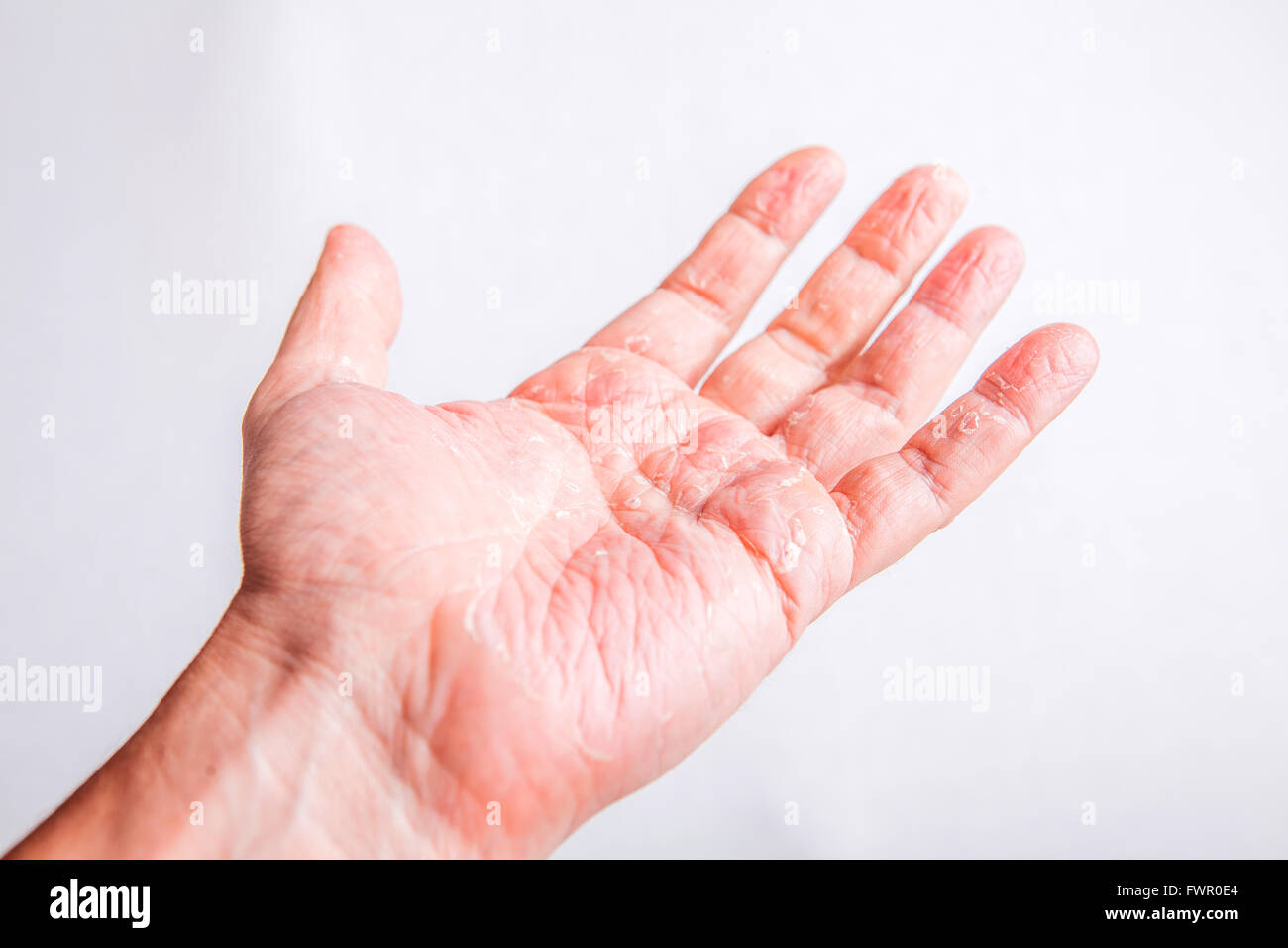 Éruption allergique Dermatite atopique peau jambe de patient Photo ...