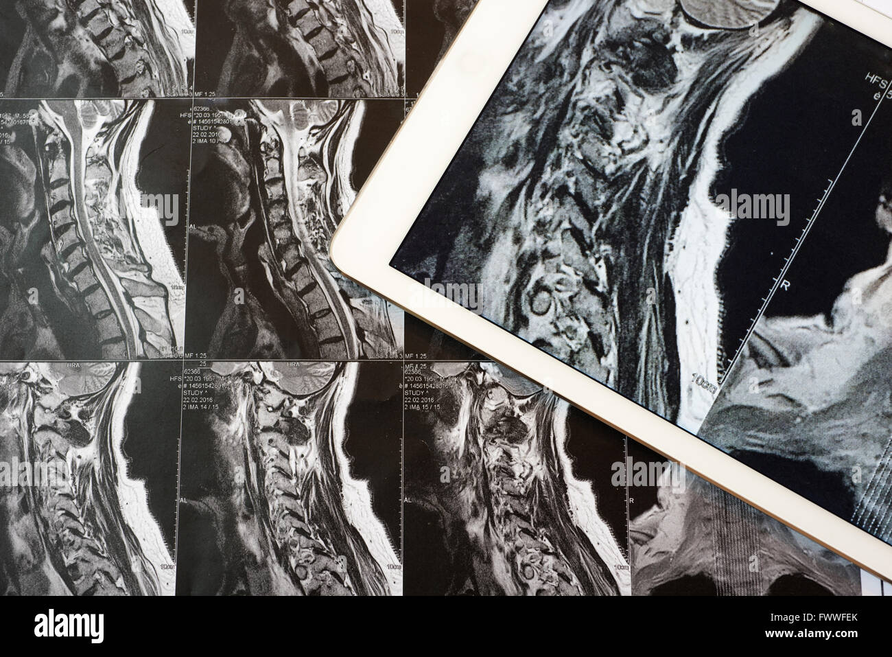 Images IRM de la colonne vertébrale avec grossissement à la ...