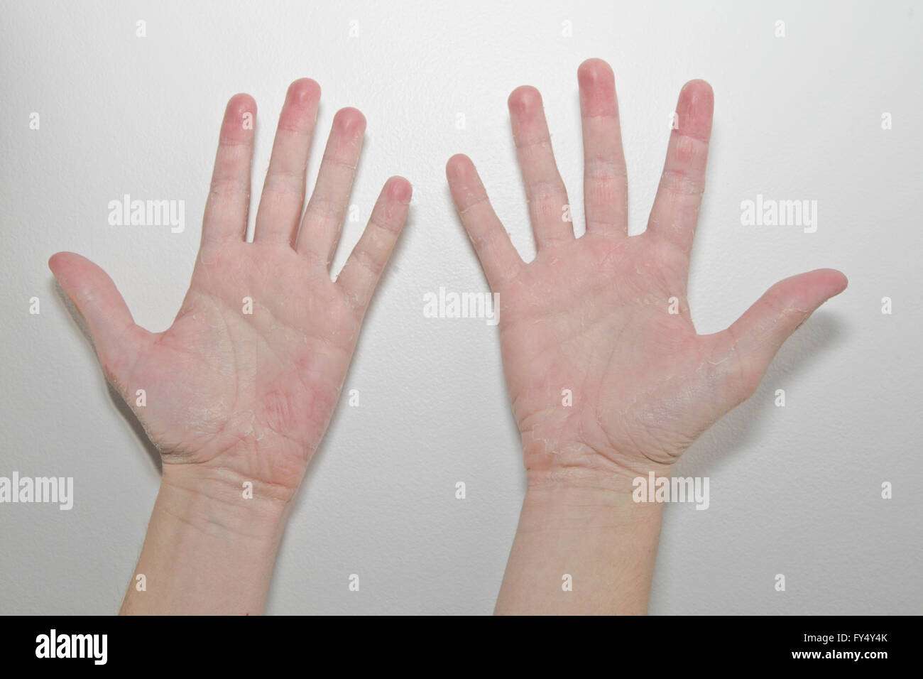 Skin rash eczema on hands Banque de photographies et d’images à haute ...