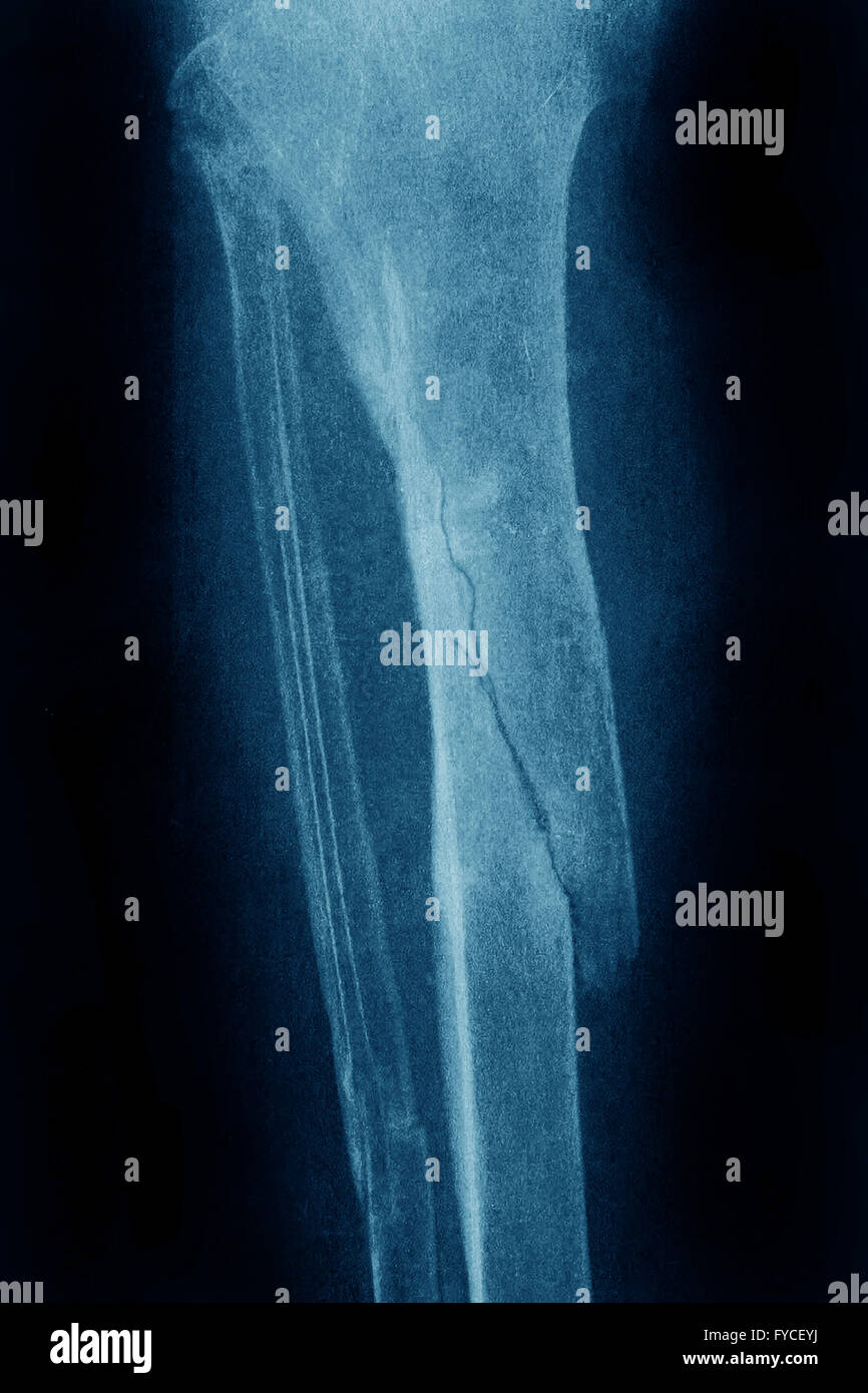 Fracture de la jambe, X-RAY Photo Stock - Alamy
