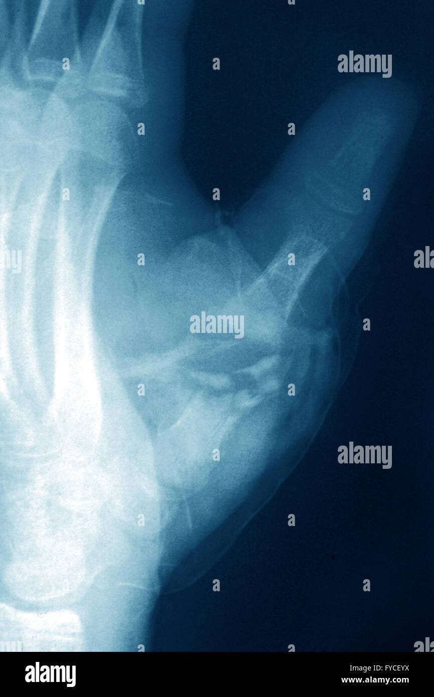 Fracture des doigts Banque de photographies et d’images à haute ...