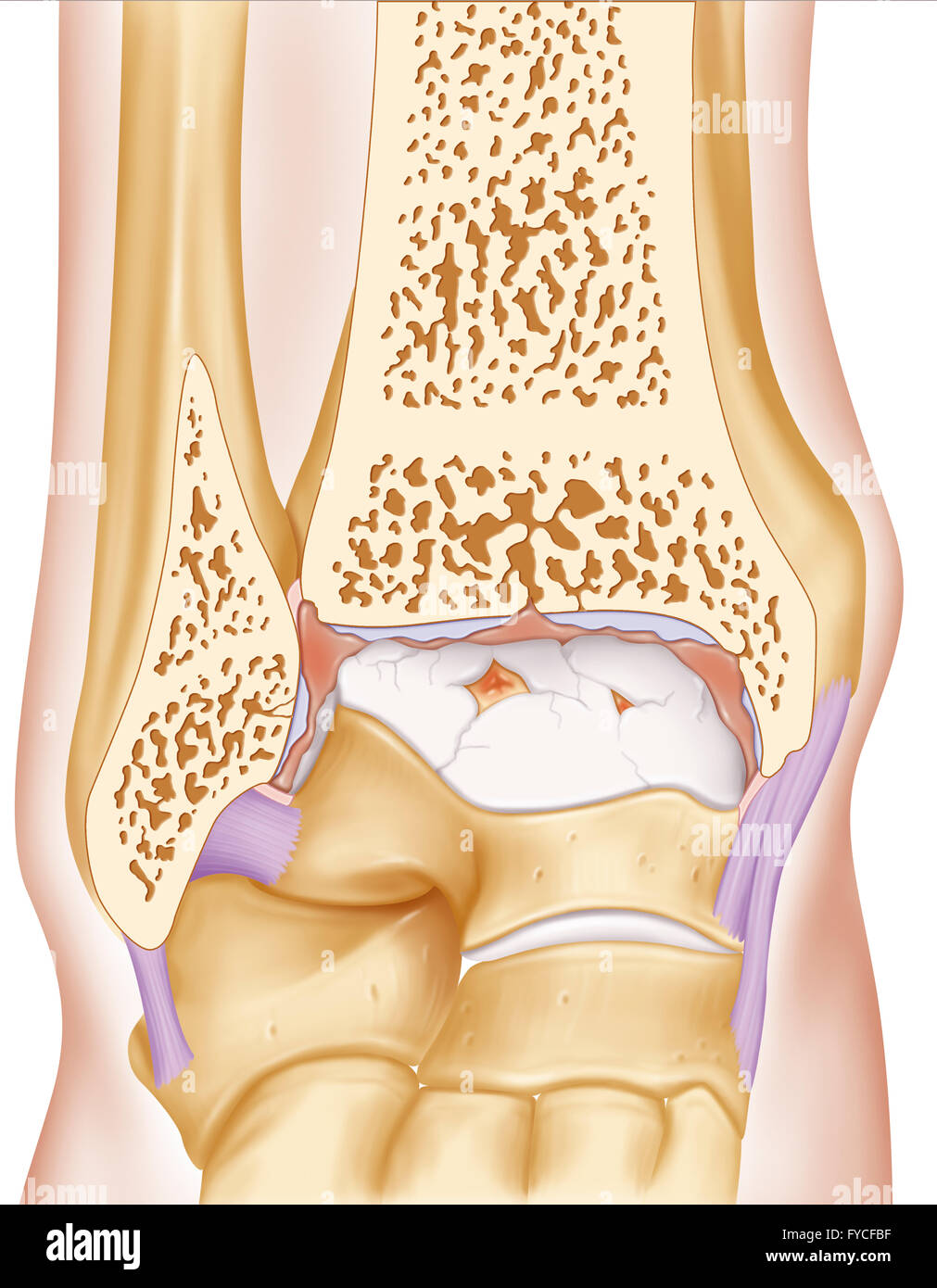 Arthrose anatomique Banque de photographies et d’images à haute ...