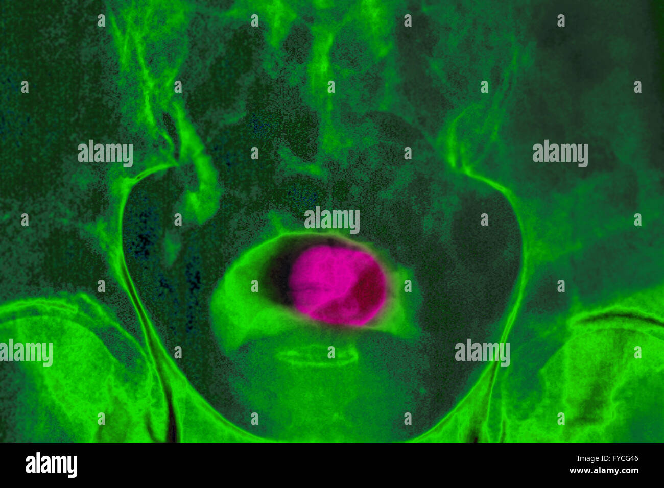 Hypertrophie prostatique Banque de photographies et d’images à haute ...