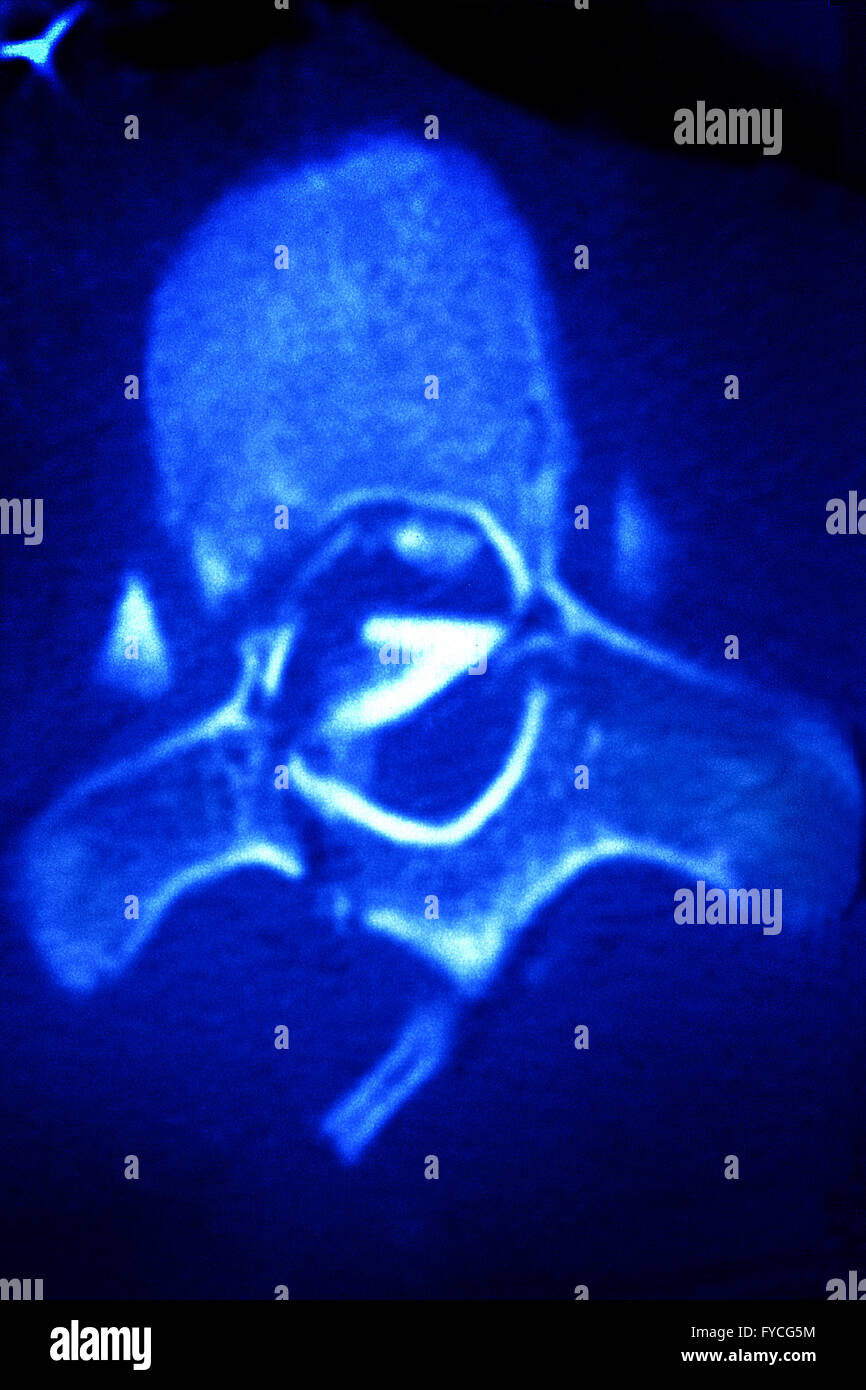 Vertebral fracture Banque de photographies et d’images à haute ...