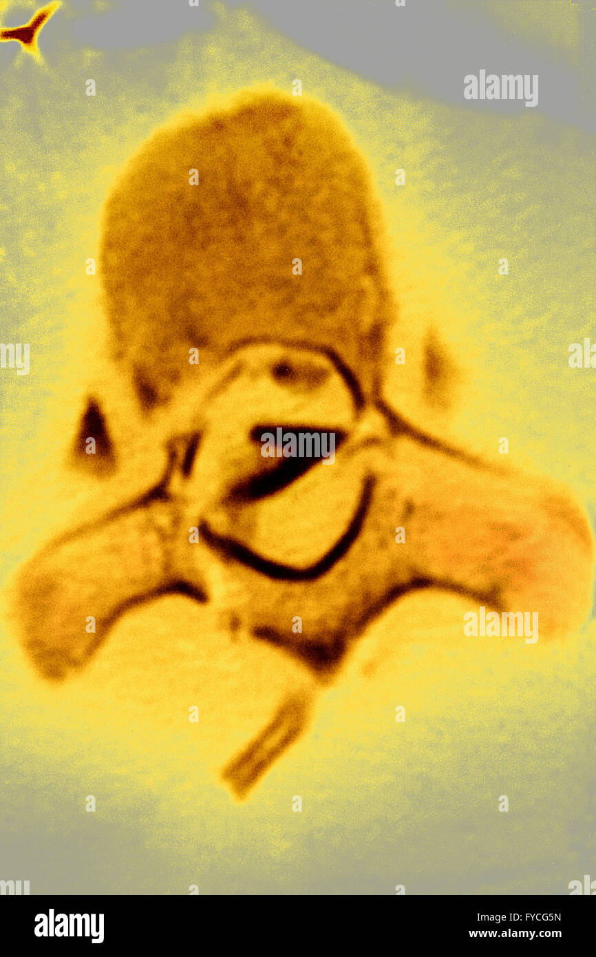 Vertebral fracture Banque de photographies et d’images à haute ...