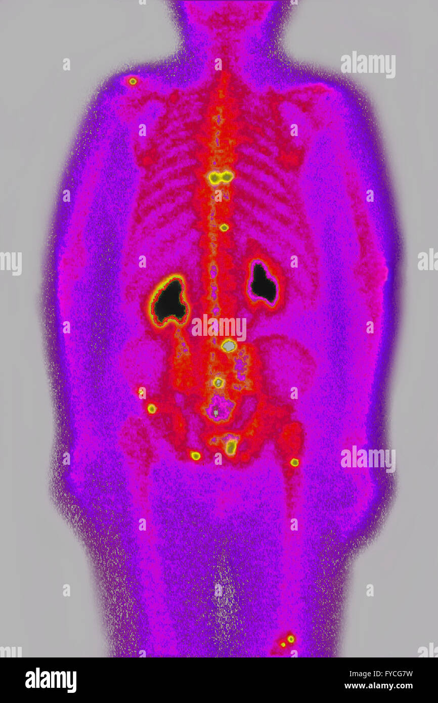 Scintigraphie isotopes Banque de photographies et d’images à haute ...