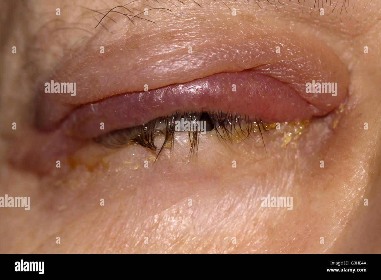 Staphylocoque doré Banque de photographies et d’images à haute ...