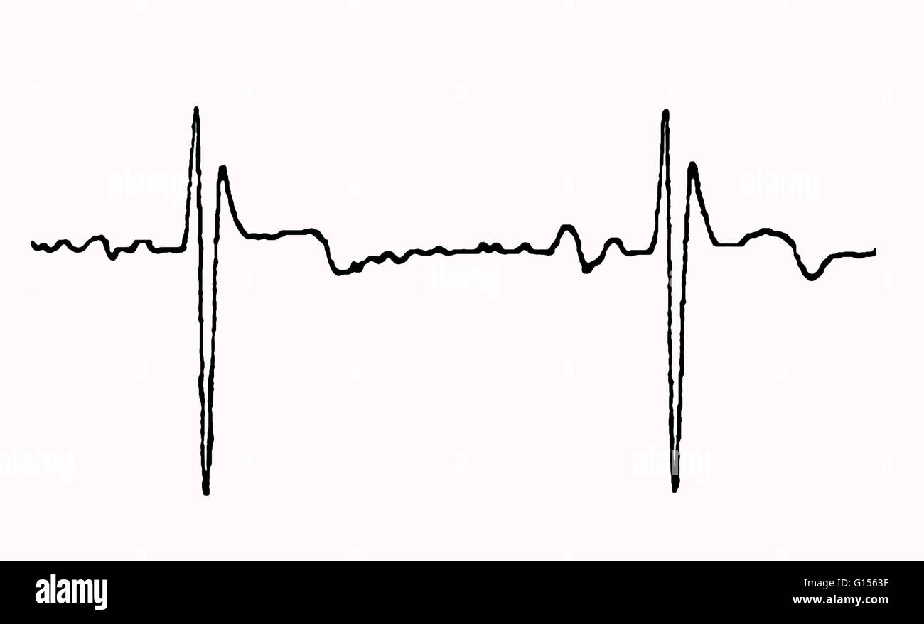 Electrocardiograma normal Banque d'images détourées - Alamy