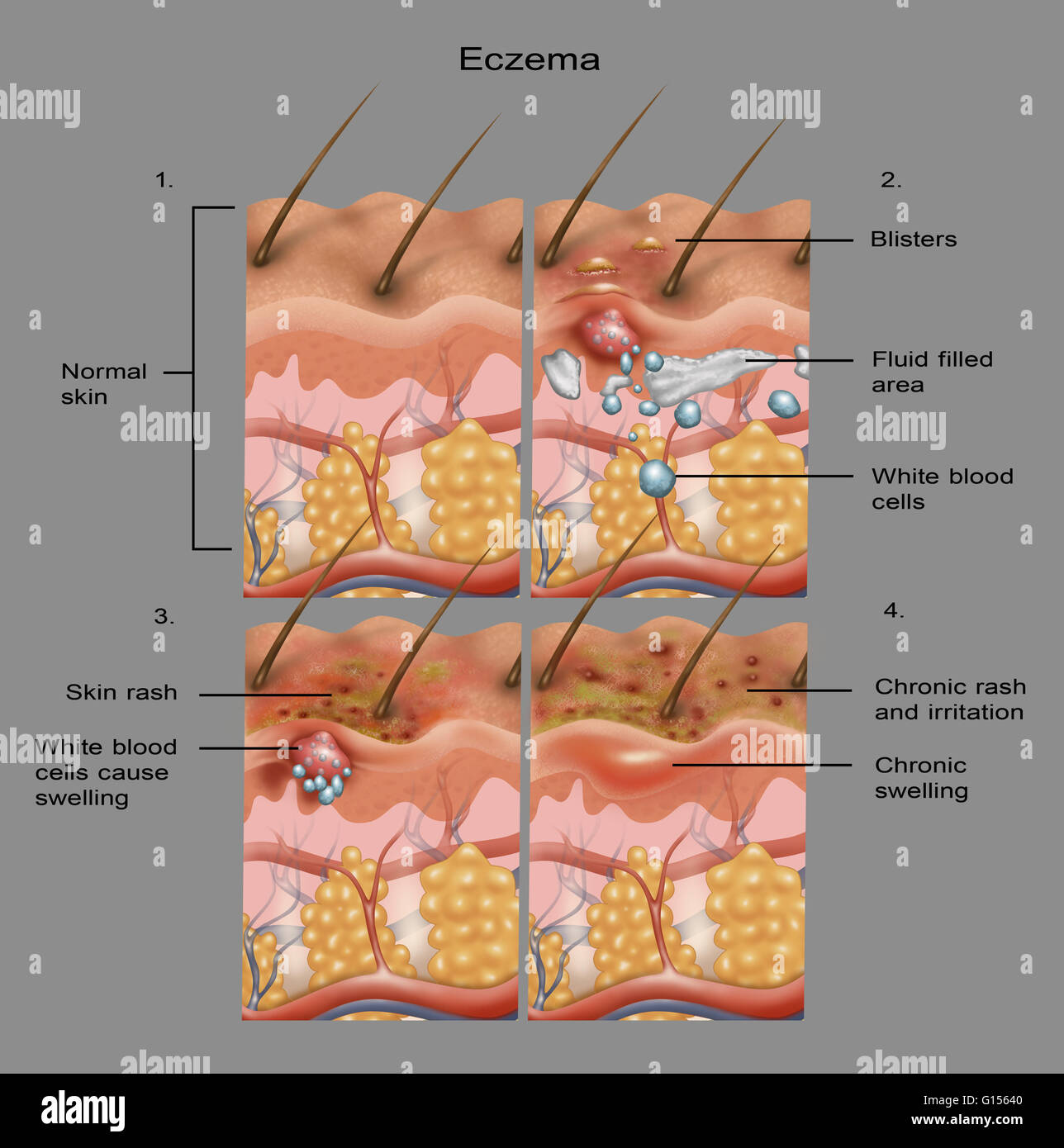 Cross-section illustration de la formation d'eczéma sur la peau en ...